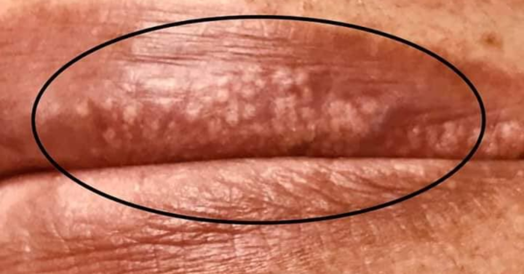 ¿De qué se tratan estos granitos que salen alrededor de los labios ...